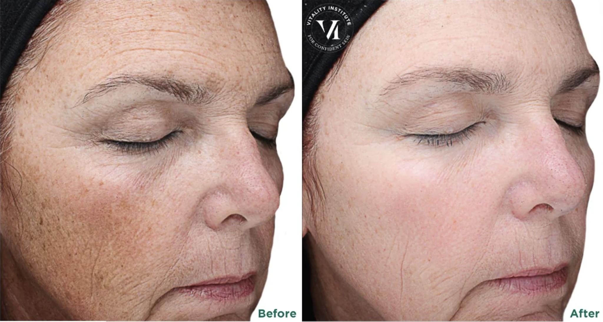 VI Peel - Jacob Bloom, MD
